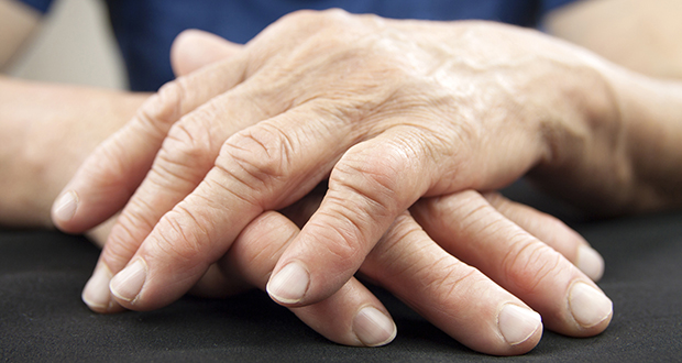 Rheumatoid arthritis: Clinical presentation, diagnosis and ...