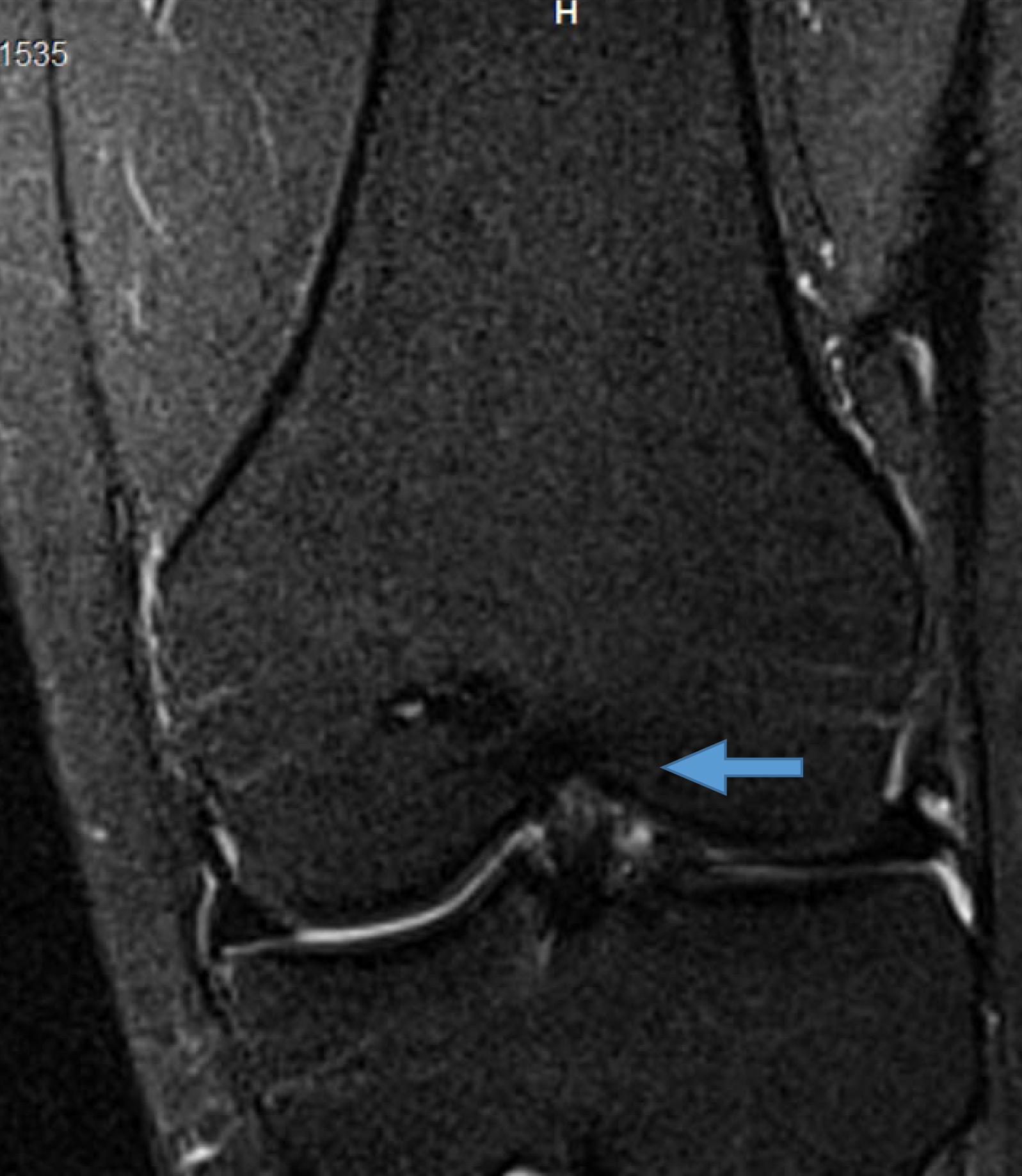 A case of anterior cruciate ligament insufficiency