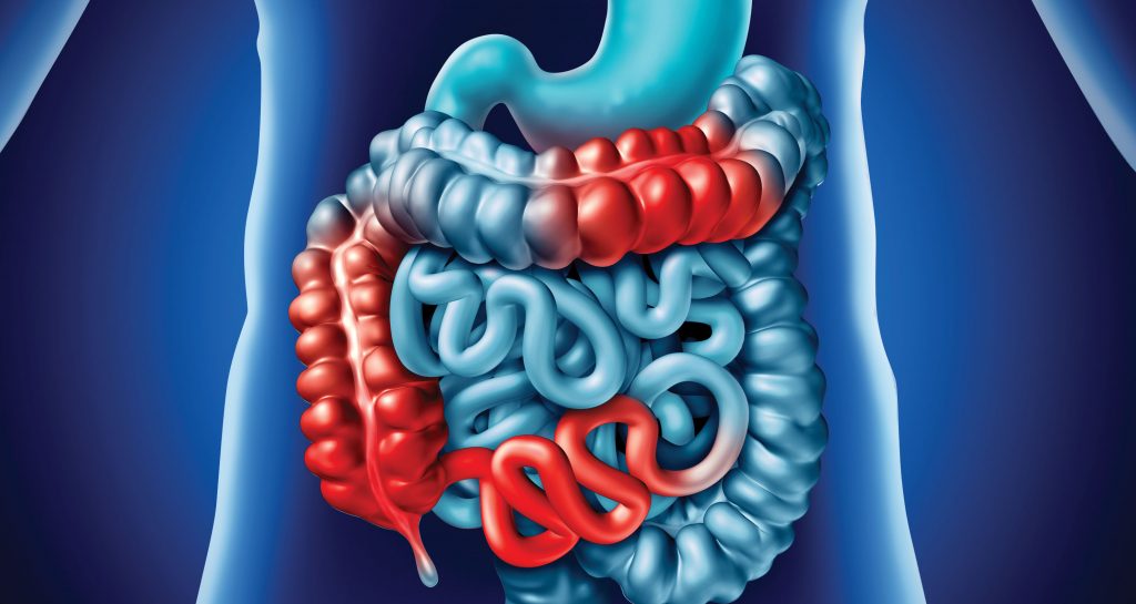 Crohn’s disease management and treatment options