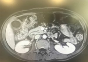 Case Report: Subclinical coeliac disease with pancreatic biliary ...