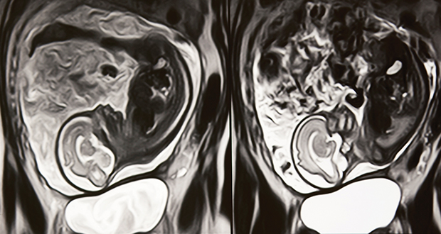 MRI ‘safely...diagnoses acute appendicitis in pregnancy’