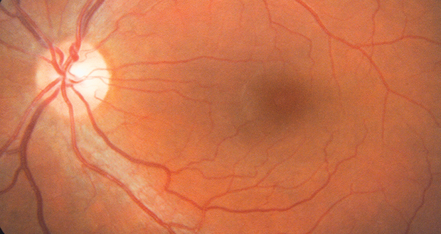 Well-being cost of inherited retinal degeneration approx €27m