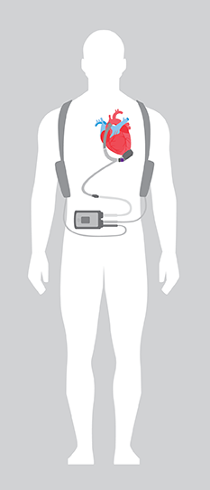 Mechanical hearts can offer critical lifeline