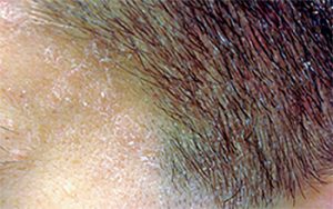 Seborrhoeic dermatitis and dandruff