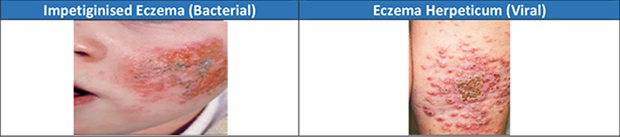 Tackling the most common skin ailment